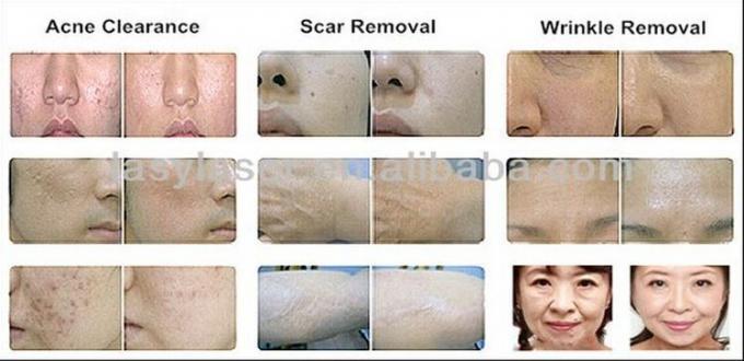CO2 Foton Skin Resurfacing Machine Viginal Laser Nd Yag Melasma